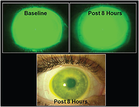 Contact Lens Spectrum | PentaVision