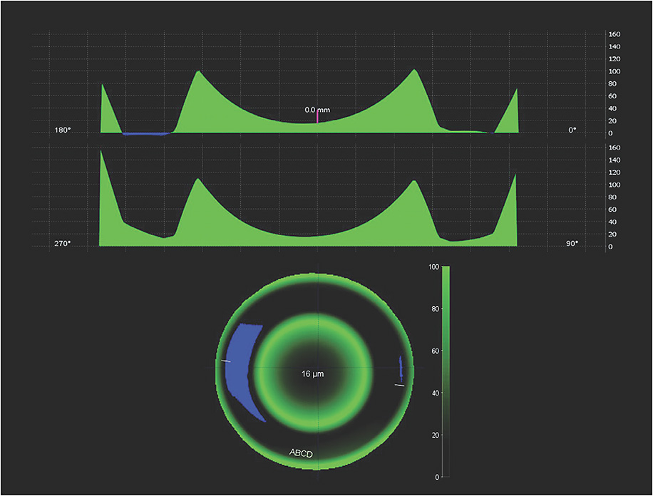 Contact Lens Spectrum | PentaVision
