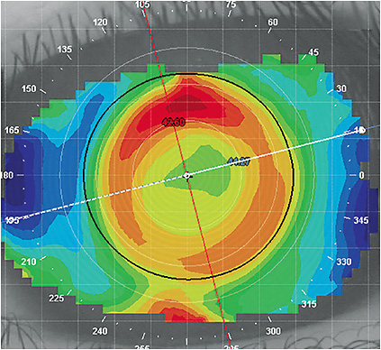 Contact Lens Spectrum | PentaVision