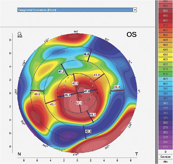 Contact Lens Spectrum | PentaVision