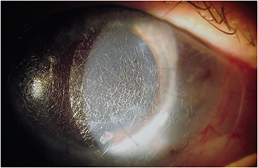 Contact Lens Spectrum | PentaVision