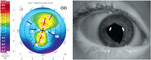 Contact Lens Spectrum | PentaVision