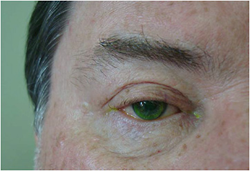 Contact Lens Spectrum | PentaVision