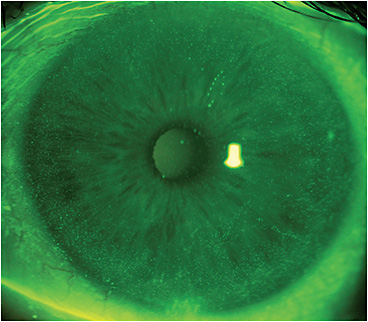 Contact Lens Spectrum | PentaVision