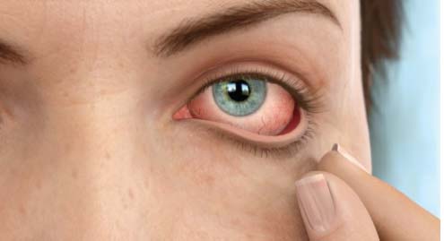 Contact Lens Spectrum | PentaVision