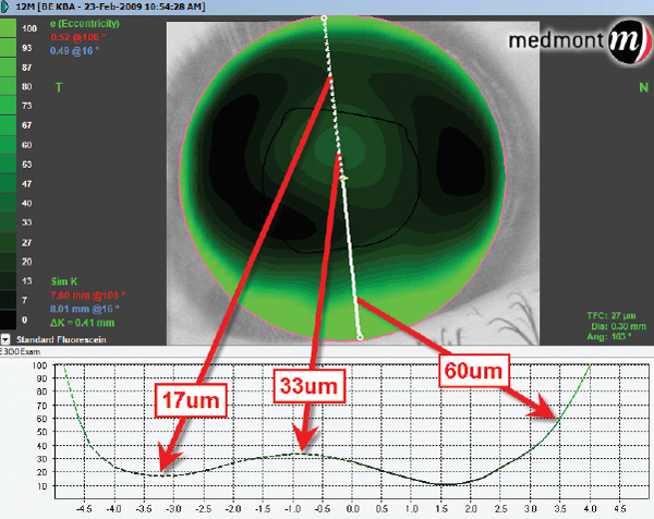 Contact Lens Spectrum | PentaVision