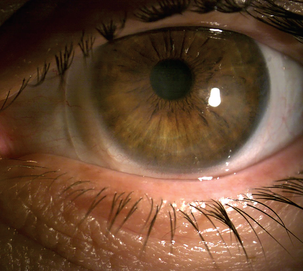 GP INSIGHTS | Contact Lens Spectrum