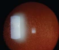 Contact Lens Spectrum | PentaVision