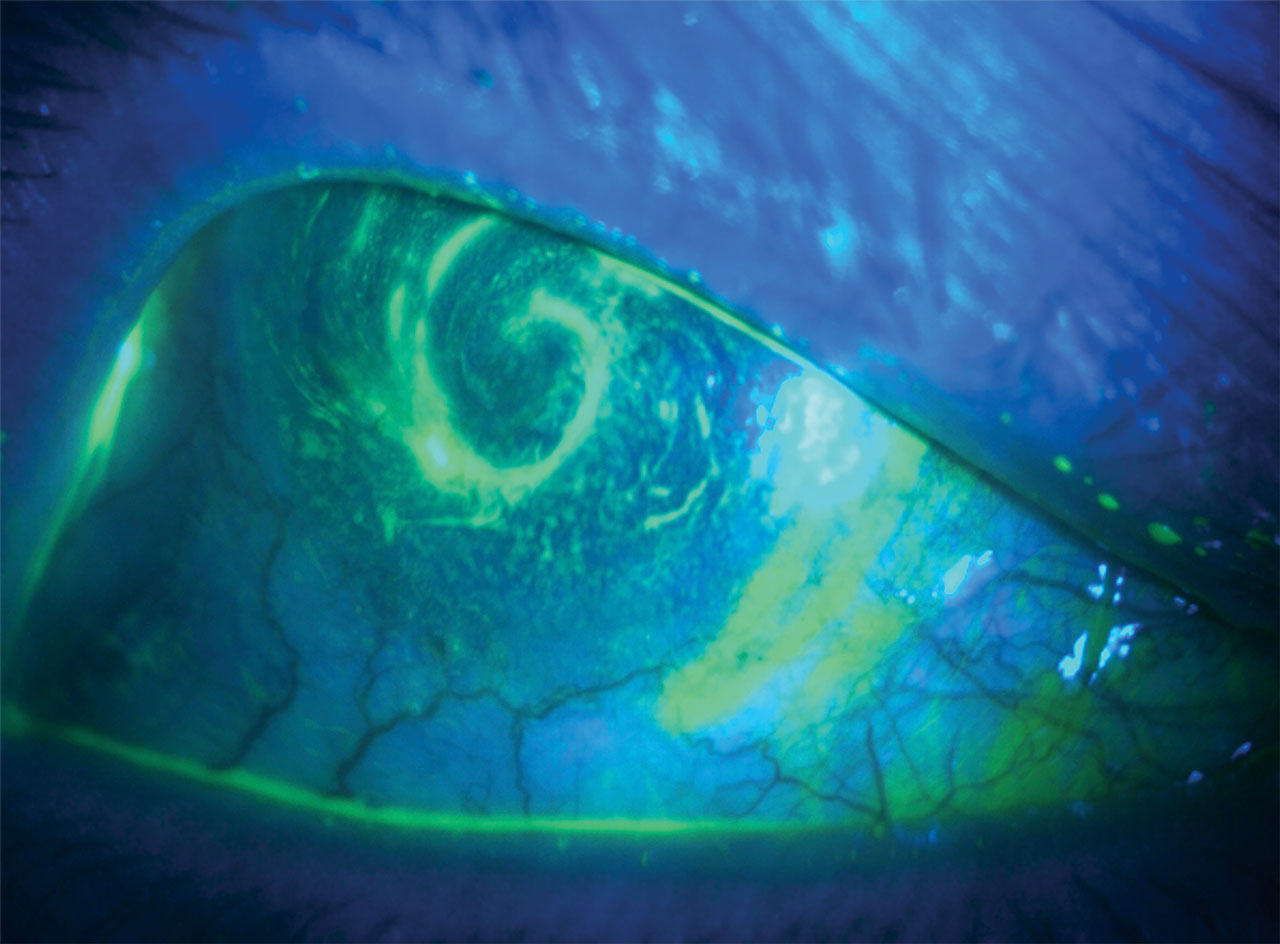 Dry Eye Dx and Tx: Preserving the Periphery | Contact Lens Spectrum
