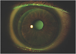 Contact Lens Spectrum | PentaVision