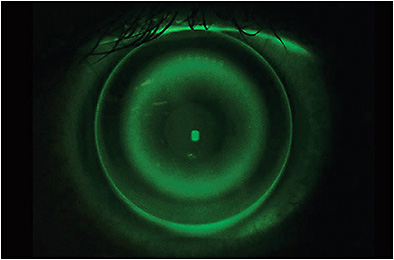 Contact Lens Spectrum | PentaVision