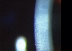 Contact Lens Spectrum | PentaVision