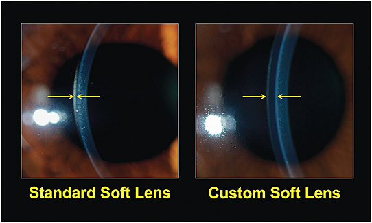 Contact Lens Spectrum | PentaVision