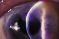 Contact Lens Spectrum | PentaVision