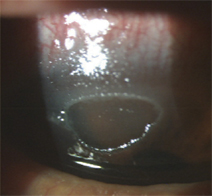 Contact Lens Spectrum | PentaVision