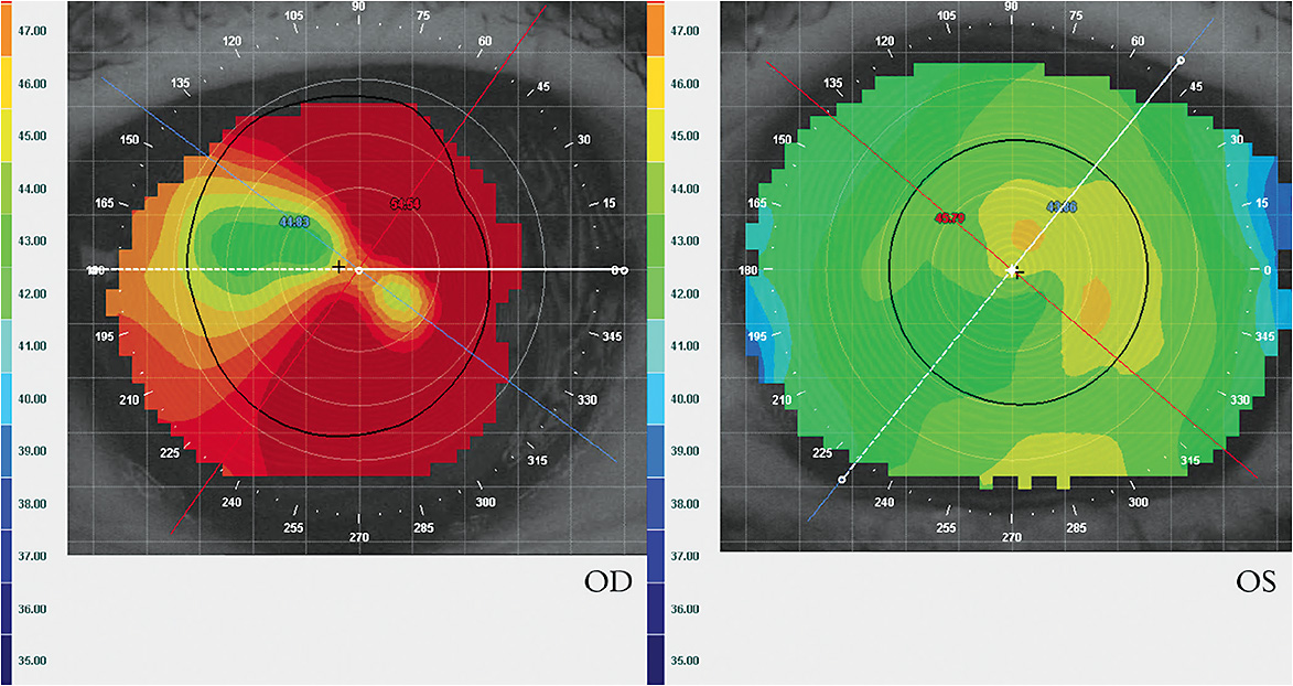 Contact Lens Spectrum | PentaVision