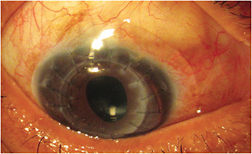Contact Lens Spectrum | PentaVision