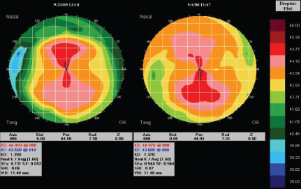Contact Lens Spectrum | PentaVision