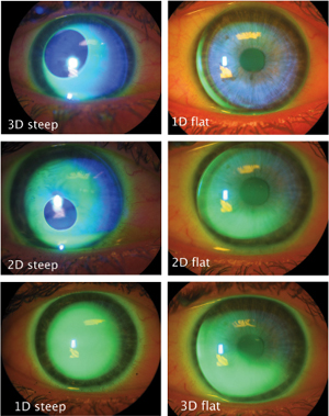 Contact Lens Spectrum | PentaVision