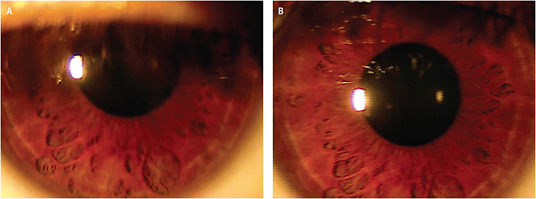 Contact Lens Spectrum | PentaVision
