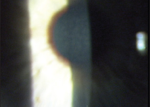 Contact Lens Spectrum | PentaVision