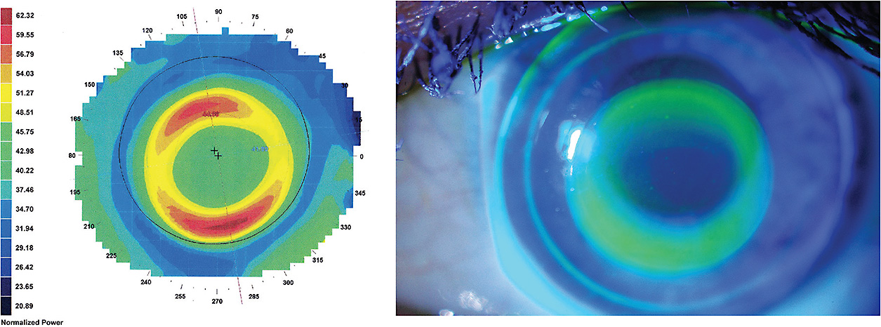 ONE SIZE DOES NOT FIT ALL | Contact Lens Spectrum
