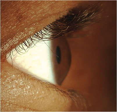 Contact Lens Spectrum | PentaVision