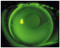 Contact Lens Spectrum | PentaVision