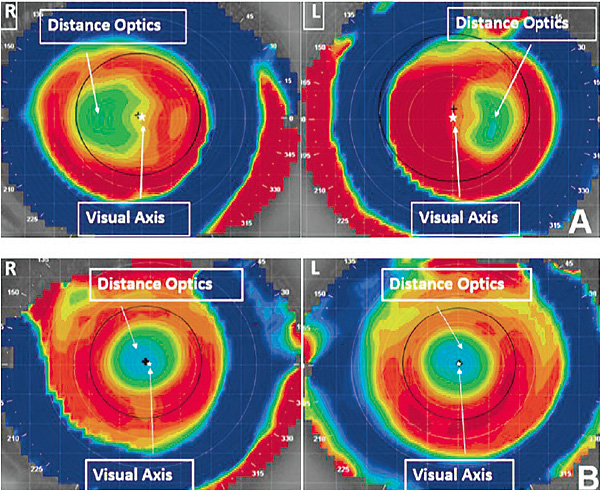 Contact Lens Spectrum | PentaVision