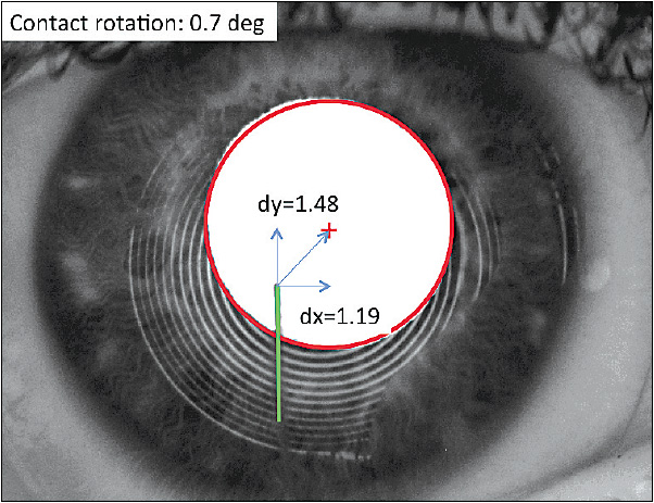 Contact Lens Spectrum | PentaVision