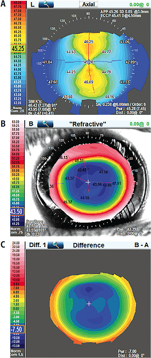 Contact Lens Spectrum | PentaVision