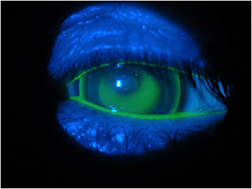 Contact Lens Spectrum | PentaVision