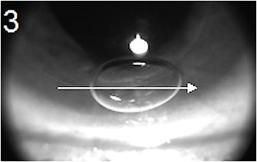 Contact Lens Spectrum | PentaVision