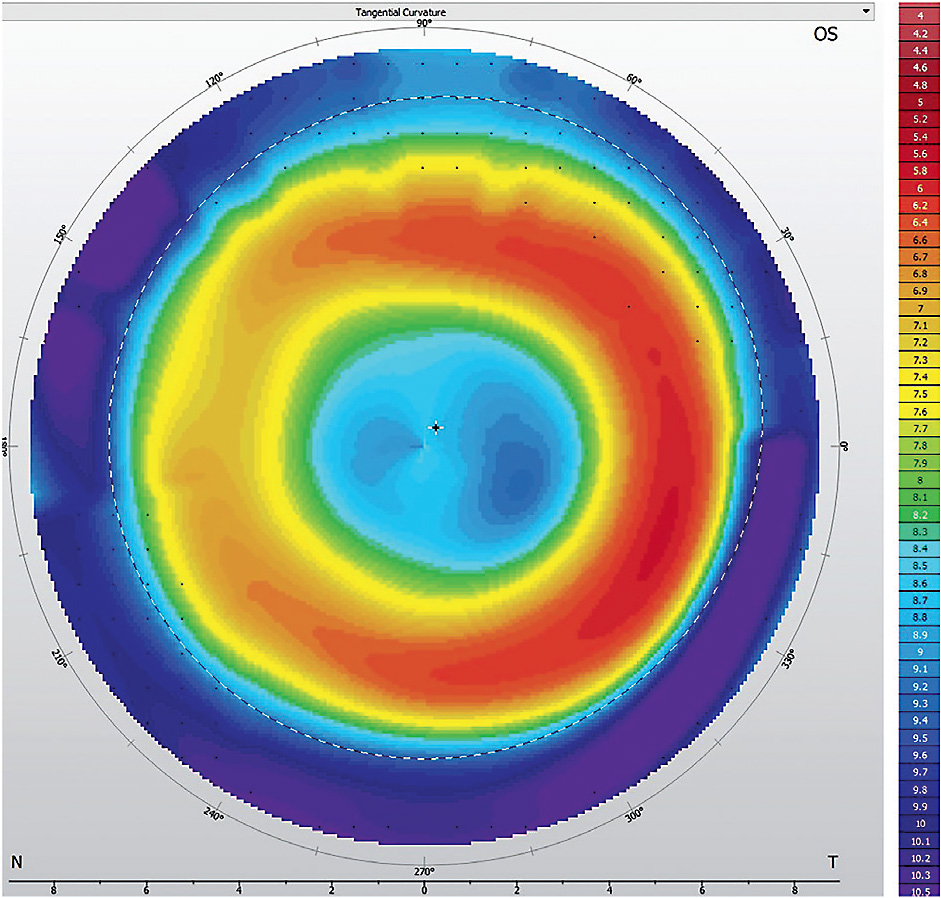 Contact Lens Spectrum | PentaVision