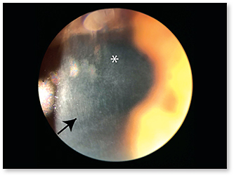 Contact Lens Spectrum | PentaVision