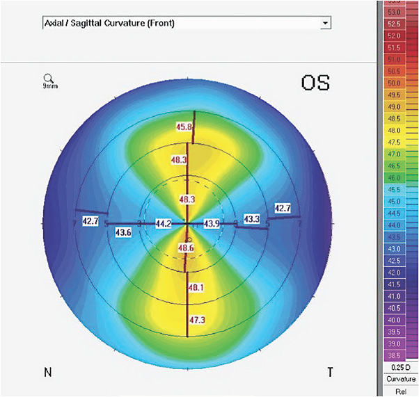 Contact Lens Spectrum | PentaVision