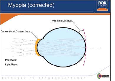 Contact Lens Spectrum | PentaVision
