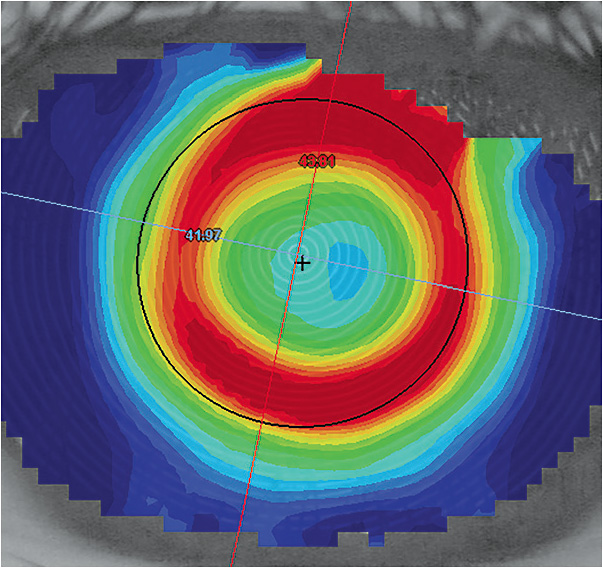 Contact Lens Spectrum | PentaVision