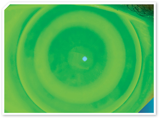 Contact Lens Spectrum | PentaVision