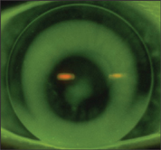 Contact Lens Spectrum | PentaVision