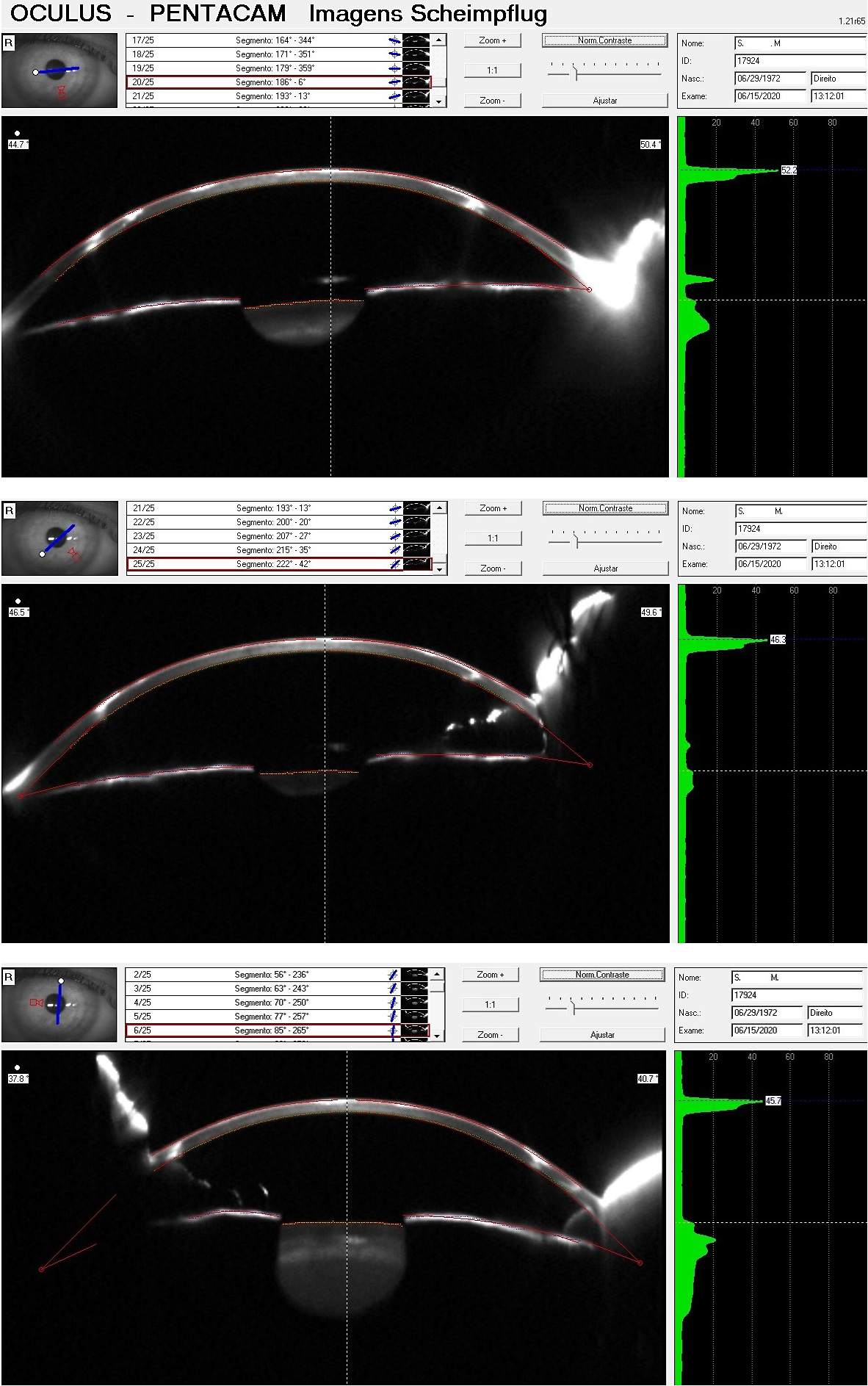 Contact Lens Spectrum | PentaVision