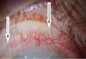 Contact Lens Spectrum | PentaVision