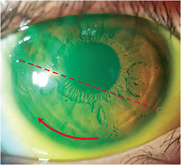 Contact Lens Spectrum | PentaVision