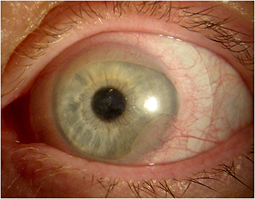 Contact Lens Spectrum | PentaVision