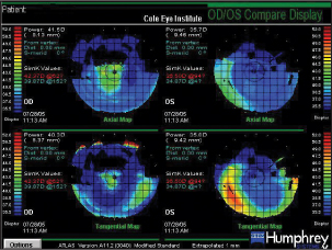 Contact Lens Spectrum | PentaVision