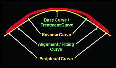 Contact Lens Spectrum | PentaVision
