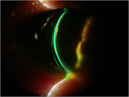 Contact Lens Spectrum | PentaVision