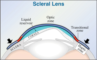 Contact Lens Spectrum | PentaVision