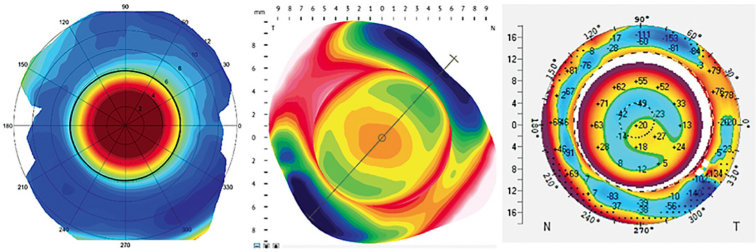 Contact Lens Spectrum | PentaVision