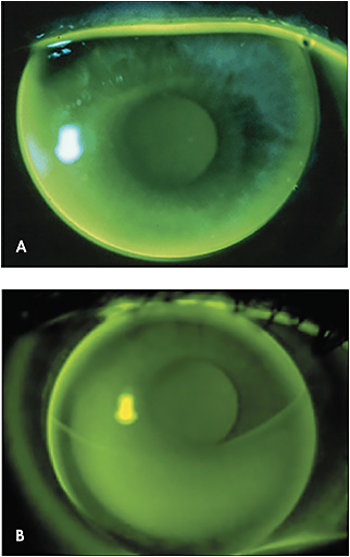 Contact Lens Spectrum | PentaVision